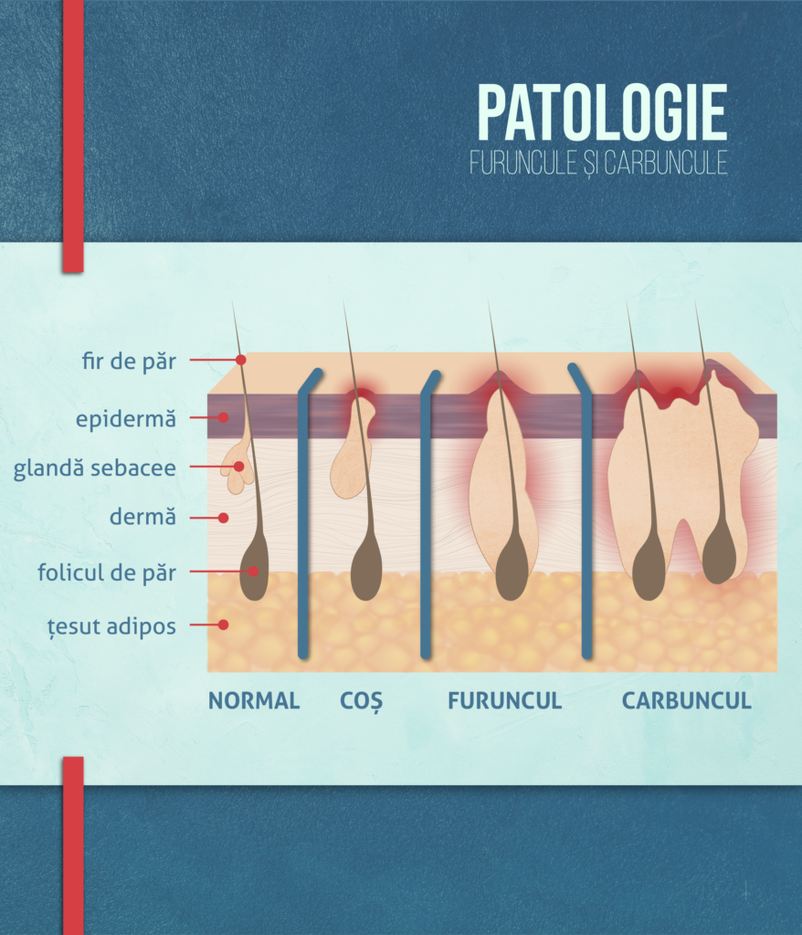Furuncule și carbuncule - Medic Chat