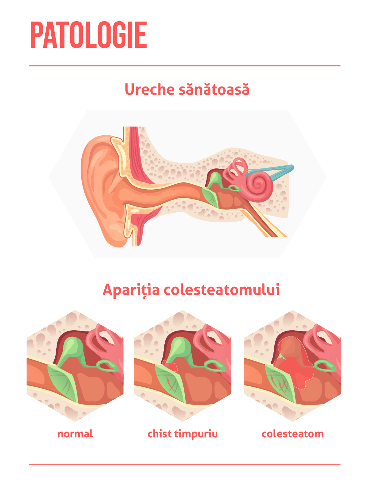 Colesteatom - Medic Chat