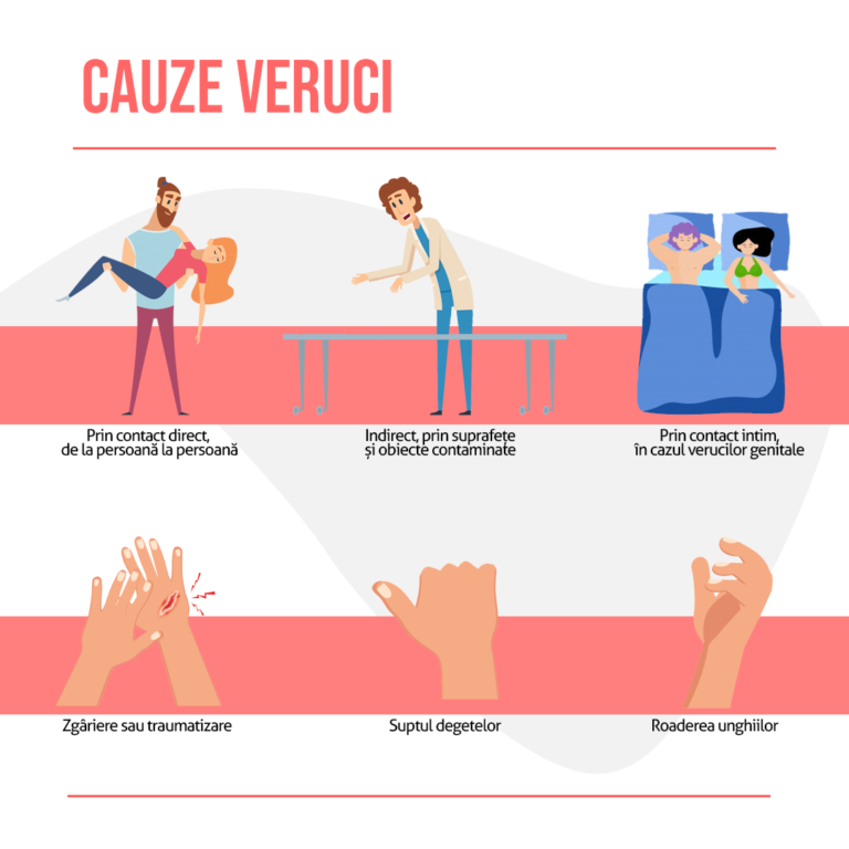 Verucile - papiloame și negi - Medic Chat