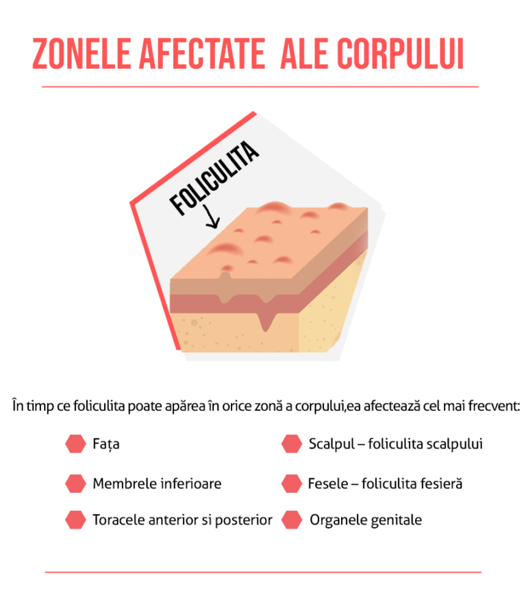 Foliculită: Cauze, Simptome, Tipuri, Tratament și Prevenire - Medic Chat
