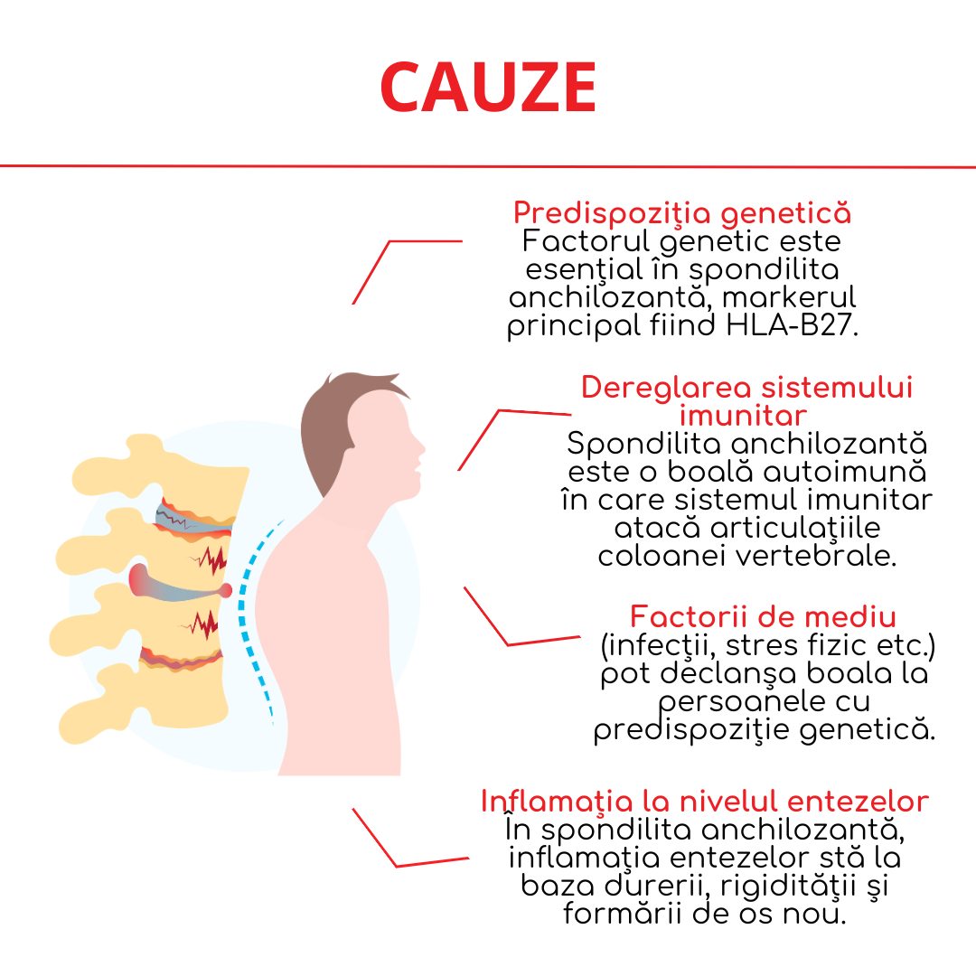 Spondilita anchilozantă: cauze, simptome, diagnostic și tratament ...